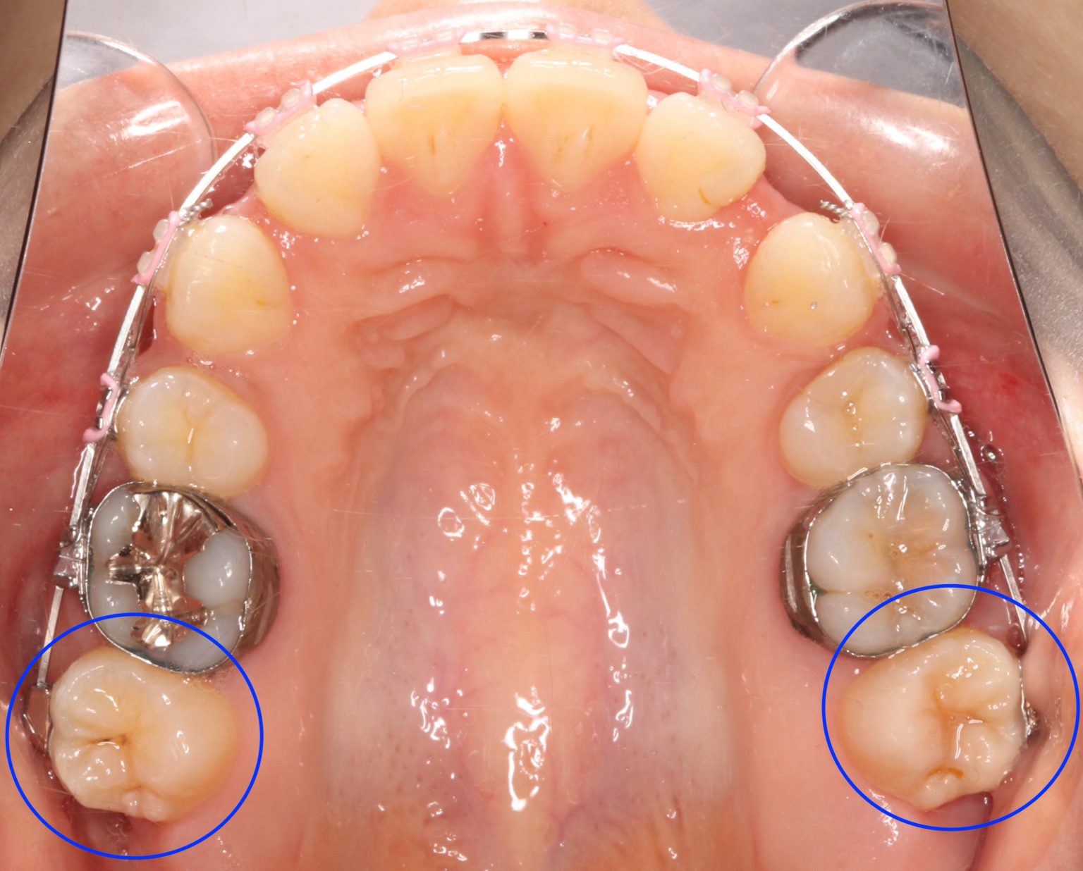 スタッフブログ⑧〜1年経過〜 | 福岡天神矯正歯科